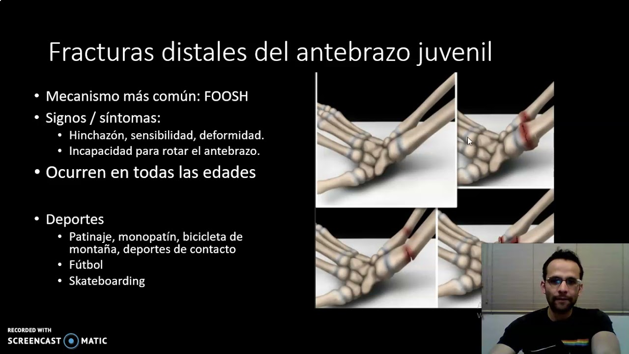 Patologia de radio y cubito distal - YouTube