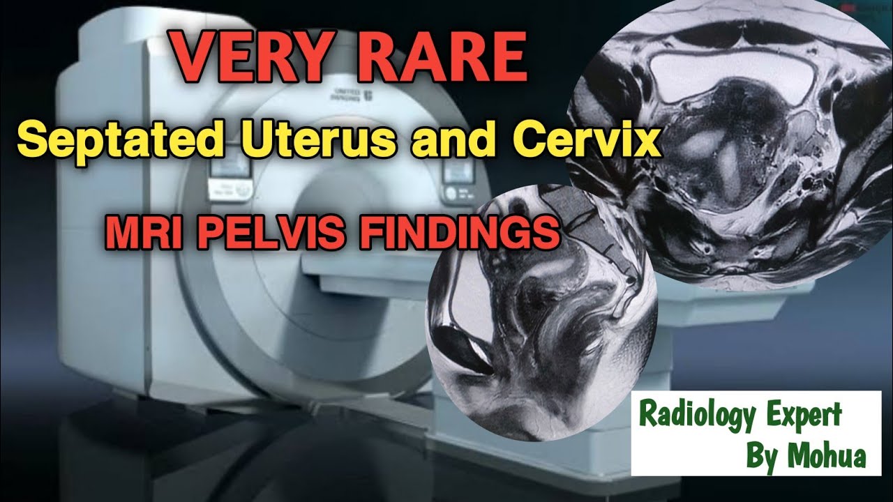 MRI PELVIS ABNORMAL FINDINGS ||SEPTATED UTERUS AND CERVIX || - YouTube