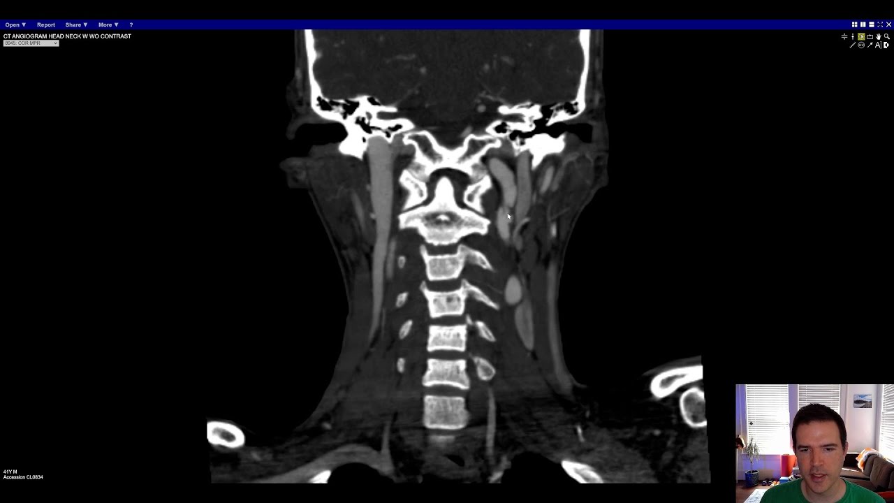 Vascular Imaging of the Head and Neck - Case D - YouTube