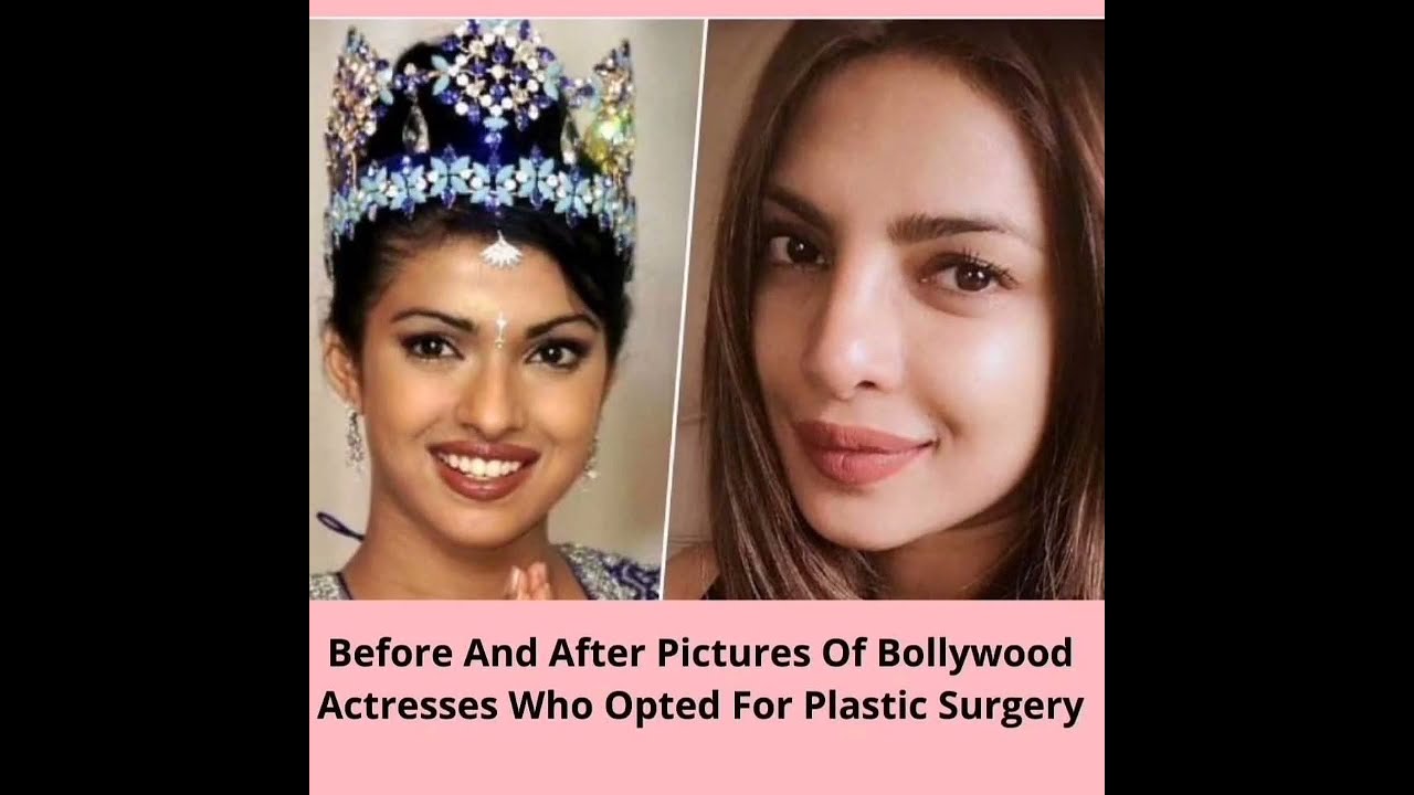 plastic surgery pics of Indian /Before and after pics /Bollywood ...
