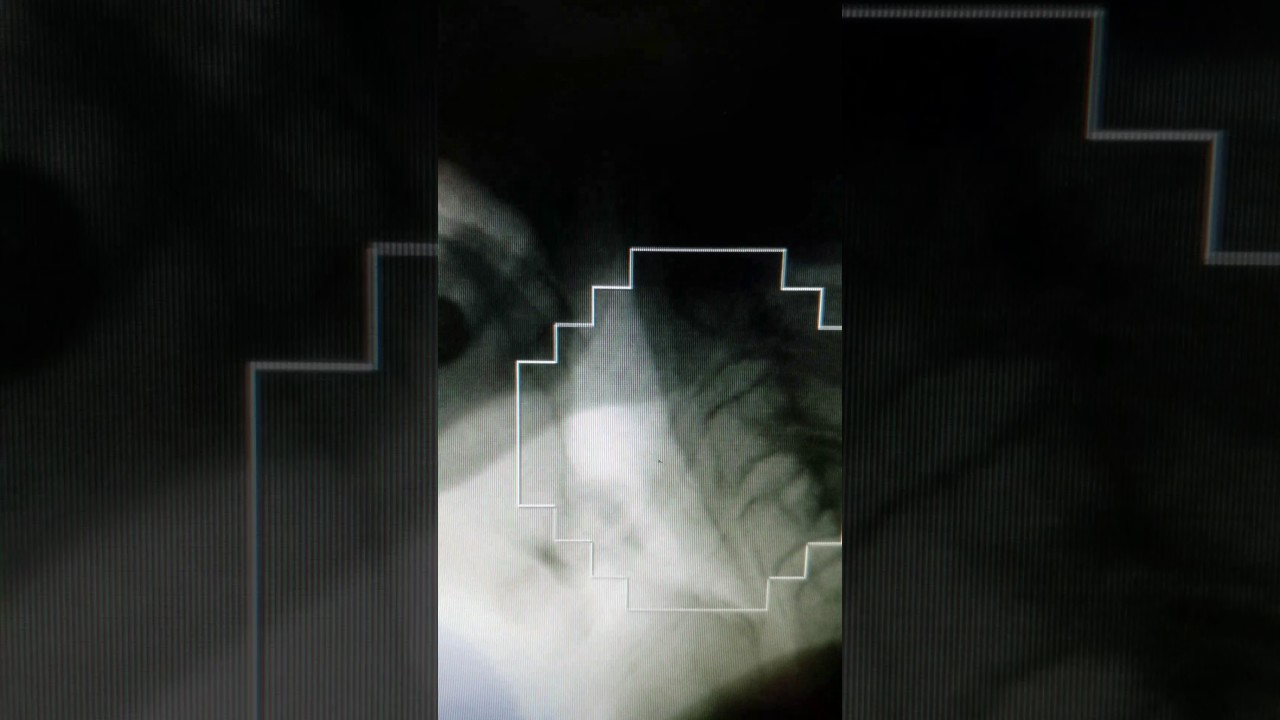 Vfss example 1(3) - YouTube