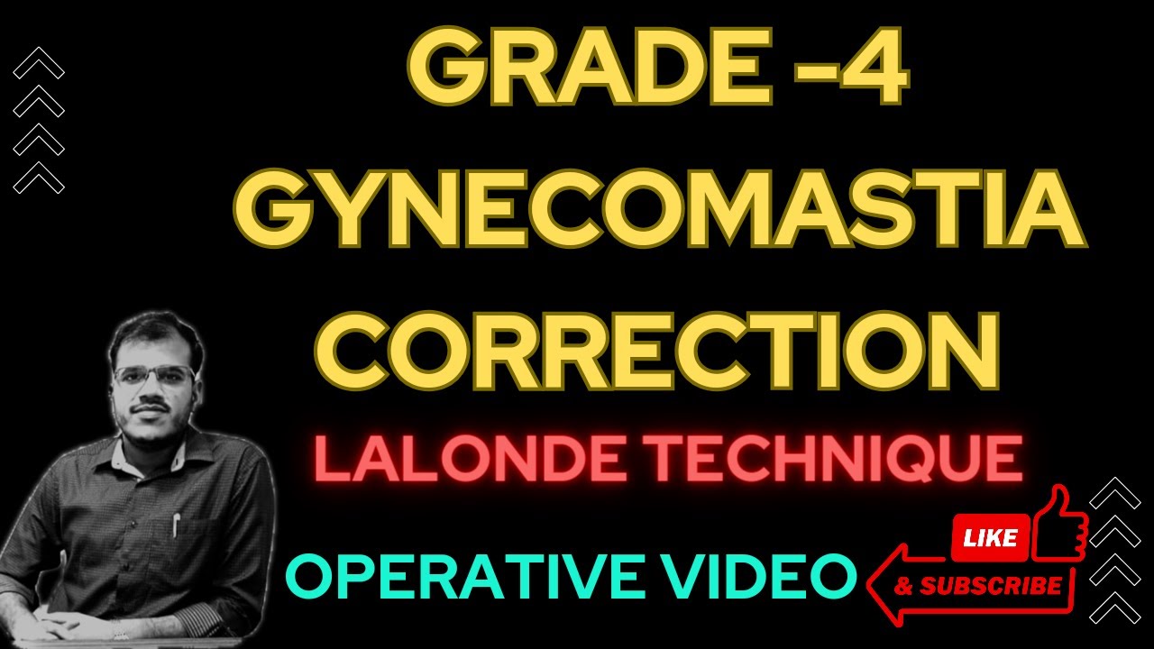 GRADE FOUR GYNECOMASTIA CORRECTION | GYNECOMASTIA SURGERY | LALONDE ...