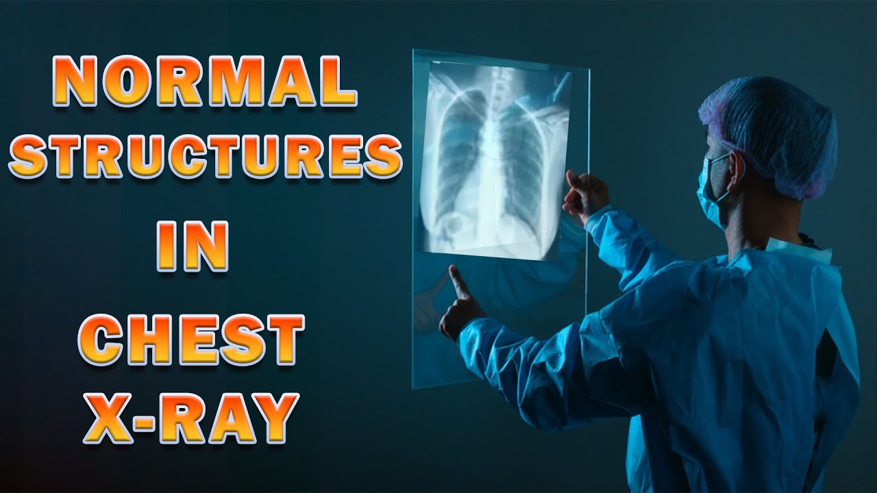 Chest X-Ray - 02 - Normal Structures & Landmarks in Chest X-Ray - YouTube