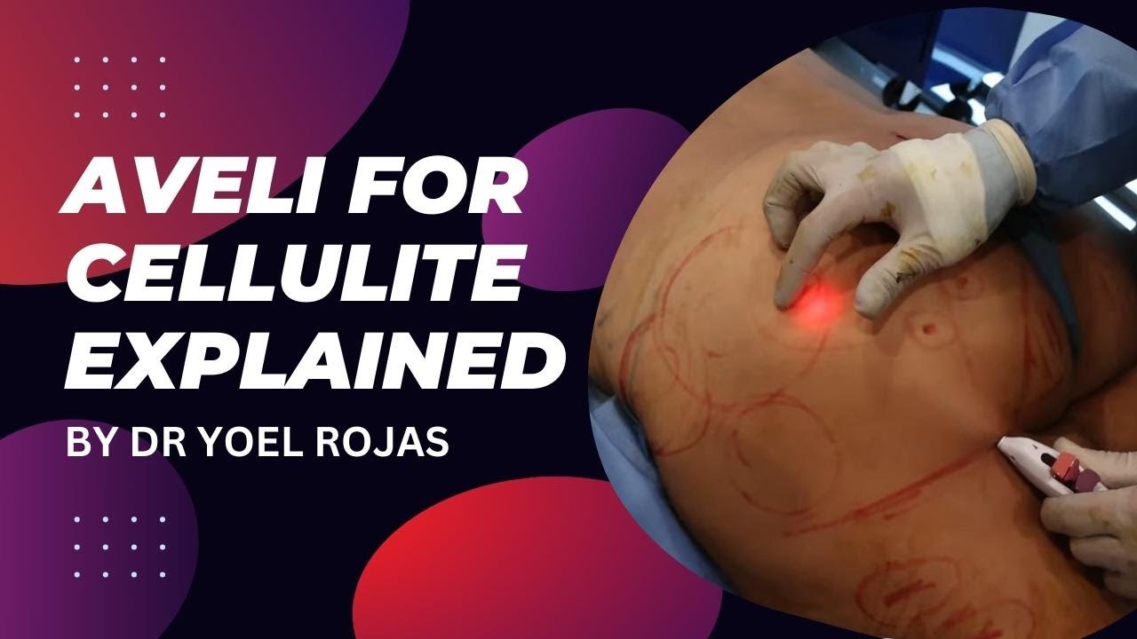 AVELI FOR CELLULITE EXPLAINED BY DR YOEL ROJAS - YouTube