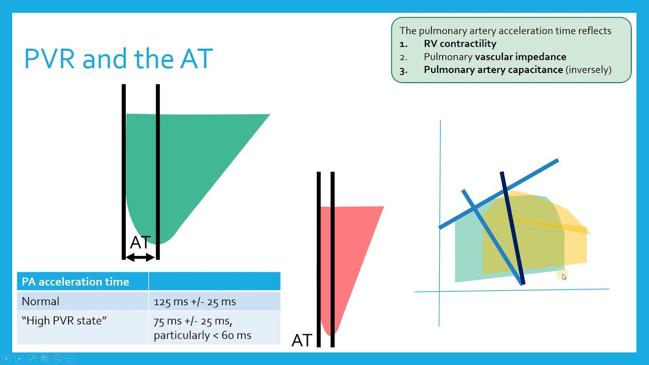 Critical Care Echo of the RV (Part 3) - Beyond TR jets: Measuring ...