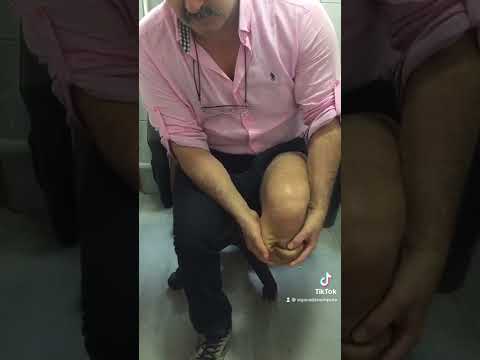 Bacak kesildikten sonra Kemiğin altında biraz et bırakılır Bu sayede kemik deriye zararve acı vermez
