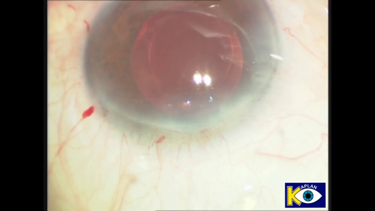 Cataract surgery in a case of severe phacodonesis with scleral fixation ...