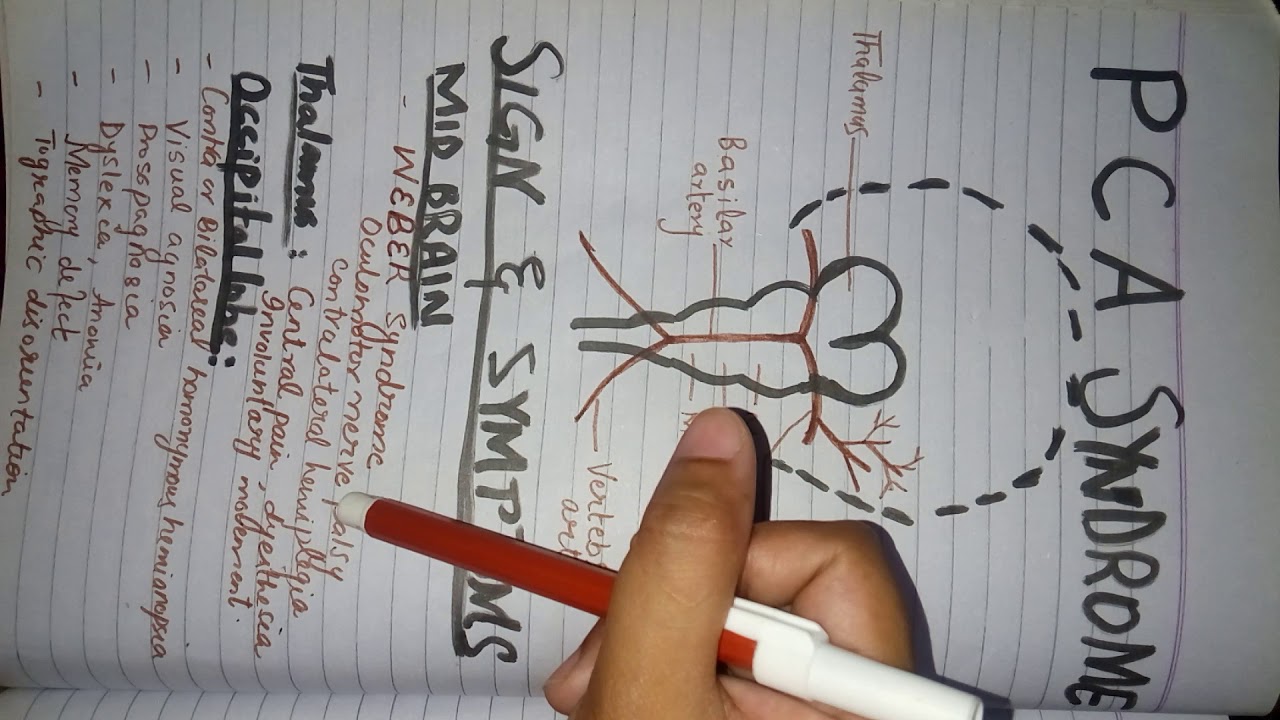 PCA( posterior cerebral artery) syndrome - YouTube