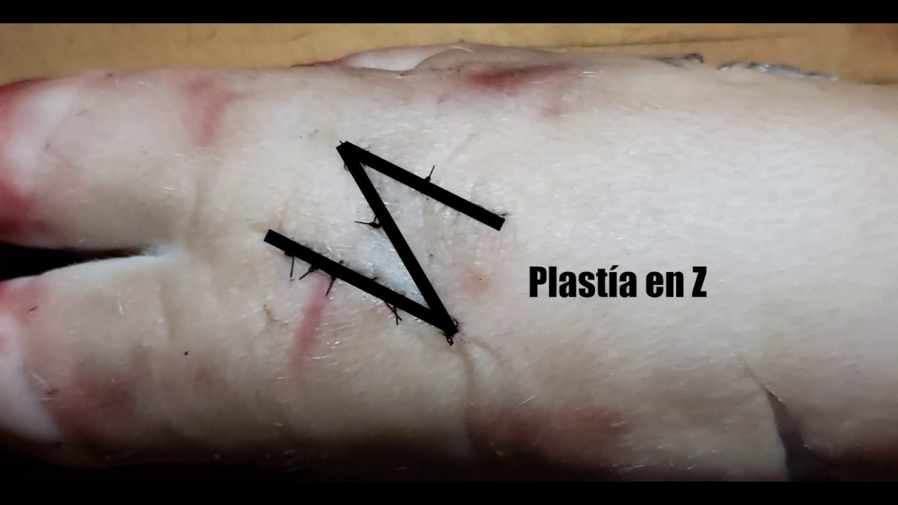 Plastía en Z - YouTube