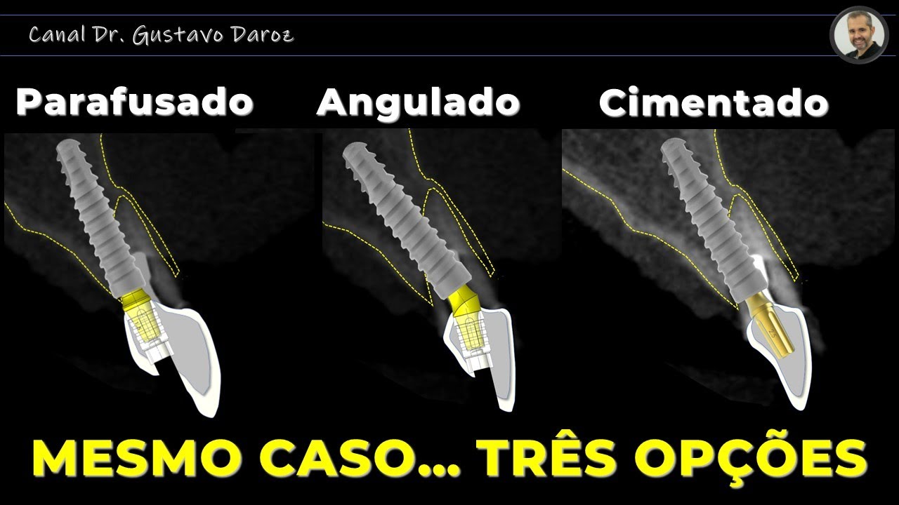 PARAFUSADO, ANGULADO ou CIMENTADO? Um Pequeno Detalhe pode Mudar Tudo ...