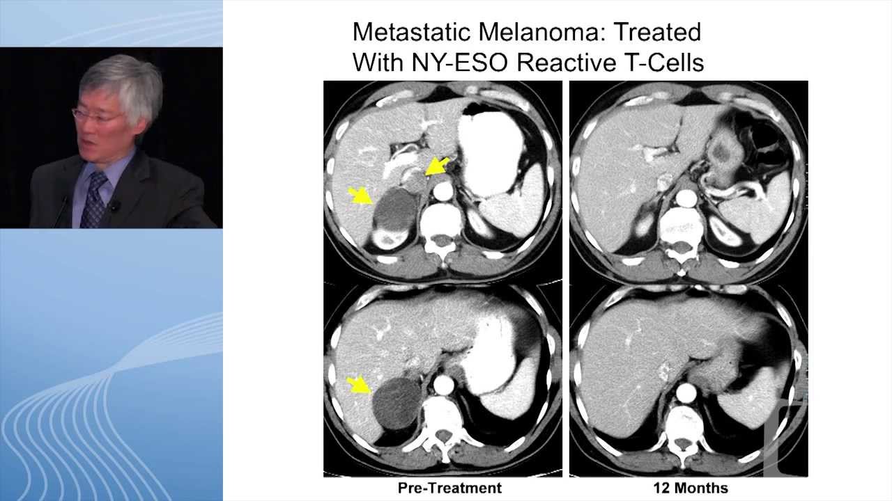 Understanding the targets recognized by TIL therapy for melanoma - YouTube