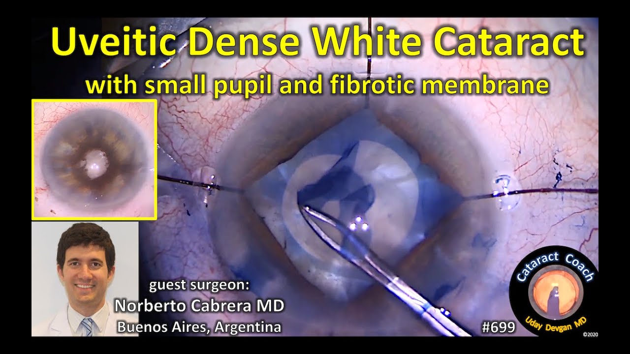 Uveitic eye with a dense white cataract, small pupil, and fibrotic ...