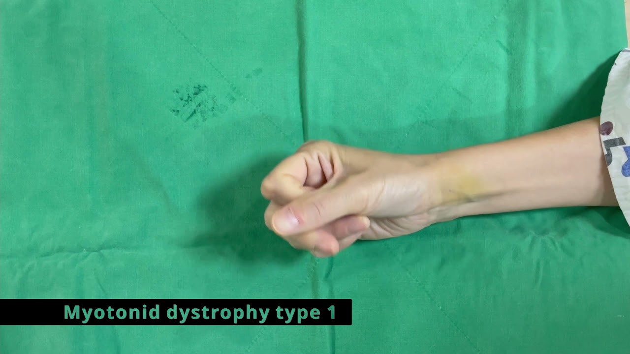 Handgrip myotonia - YouTube