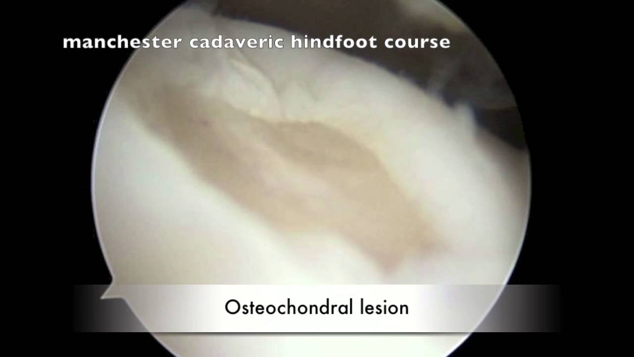 examples of arthroscopic (keyhole) ankle surgery - YouTube