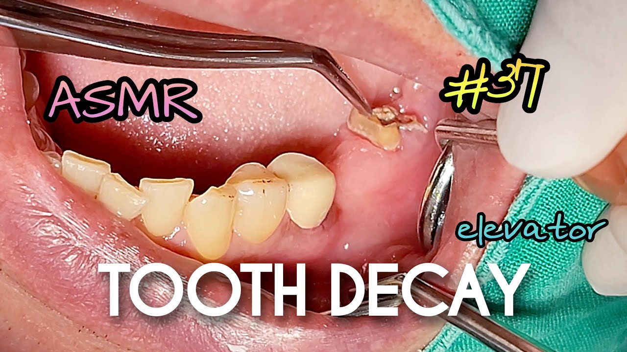 [ASMR] Severely Broken, Tooth Decay Extraction - YouTube