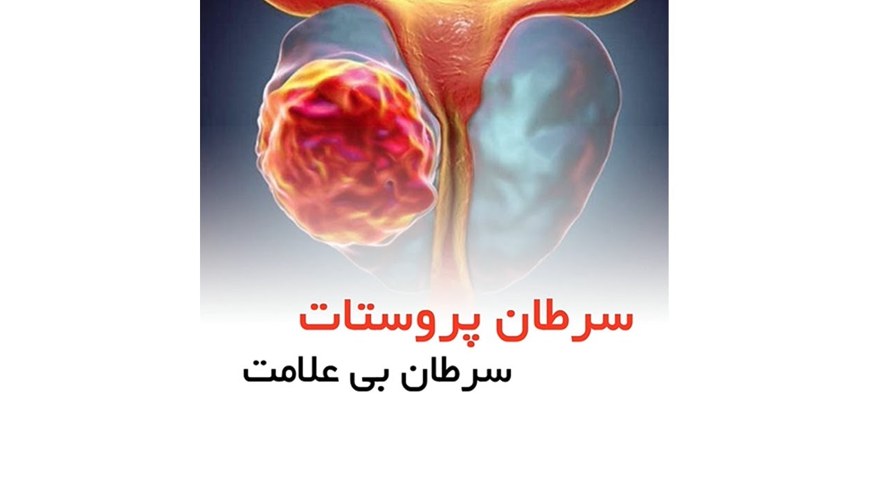 سرطان پروستات سرطان بی علامت دکتر میرصادقی Youtube