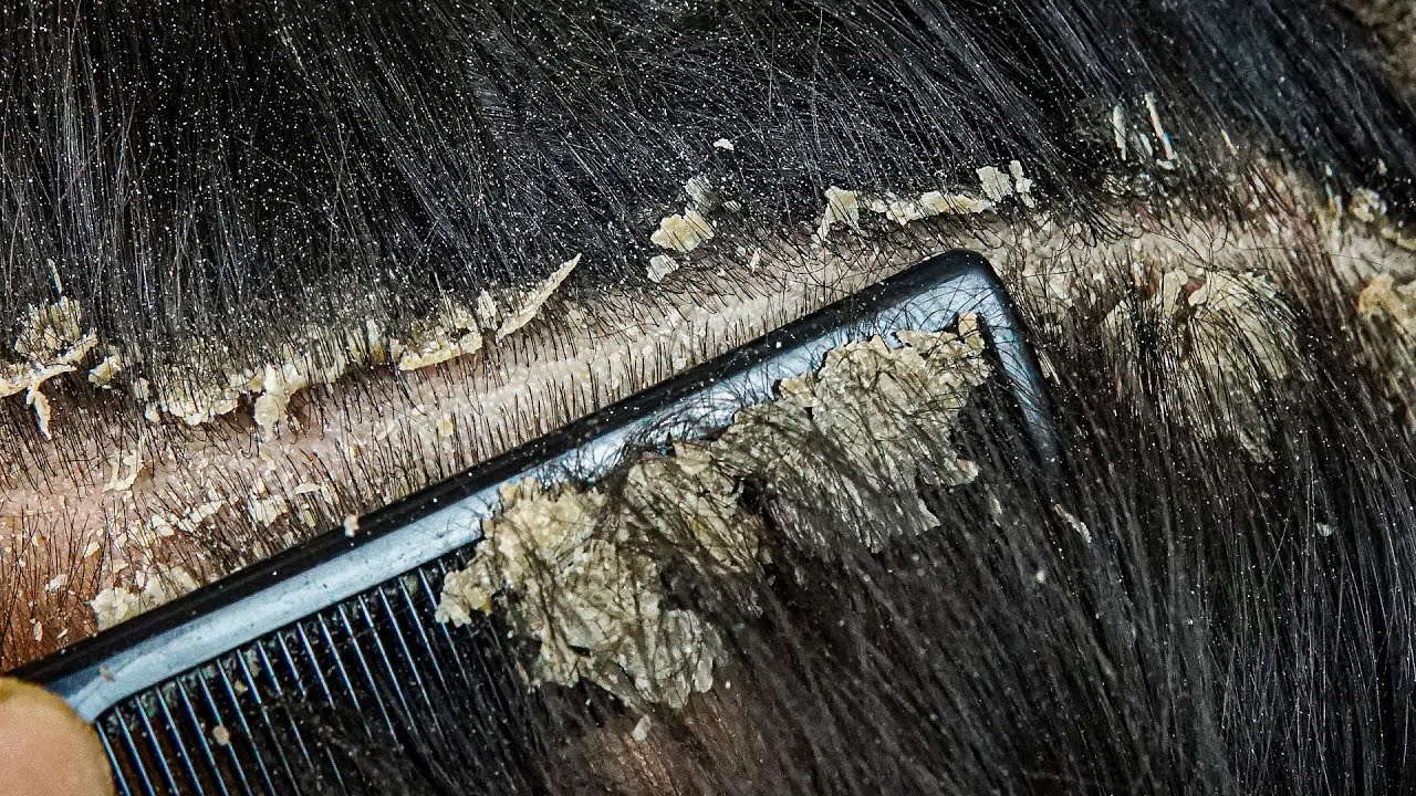 Satisfying Dandruff Cleaning, Comb Brush for Ultimate Relaxation # ...