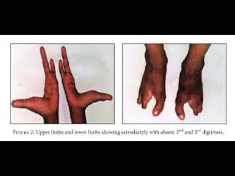 Ectrodactyly ; Congenital limb abnormality; Causes, Presentation ...