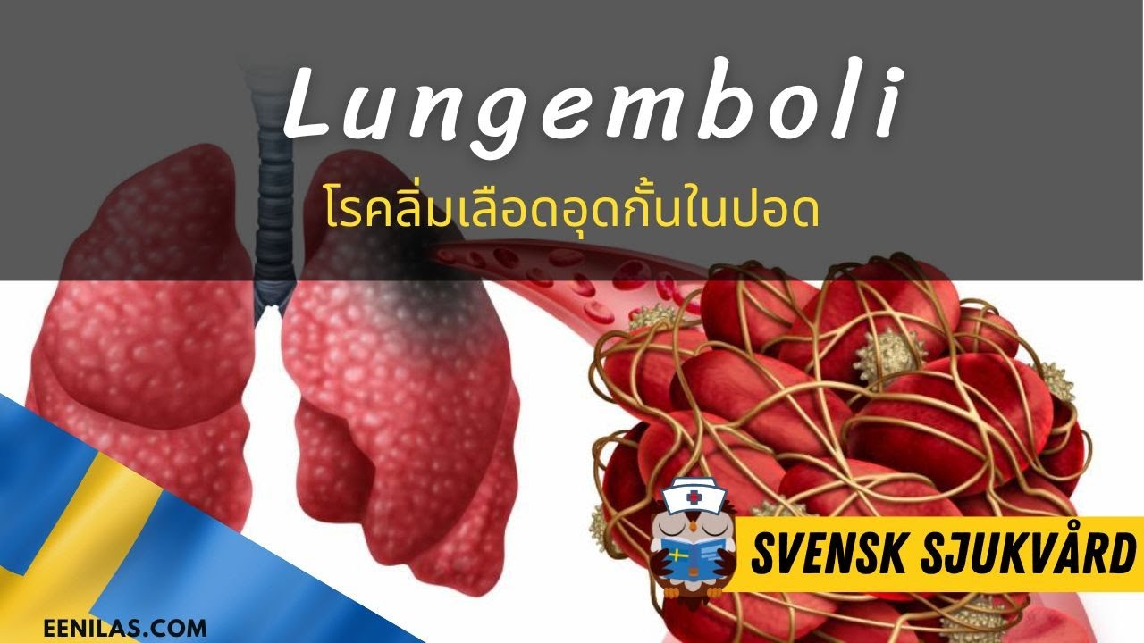 #คอร์สเตรียมความพร้อมภาษาสวีเดนทางการแพทย์ ลิ่มเลือดอุดกั้นในปอด ...