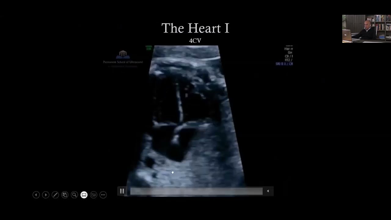 How to scan the fetal heart: the basics you should know. - YouTube