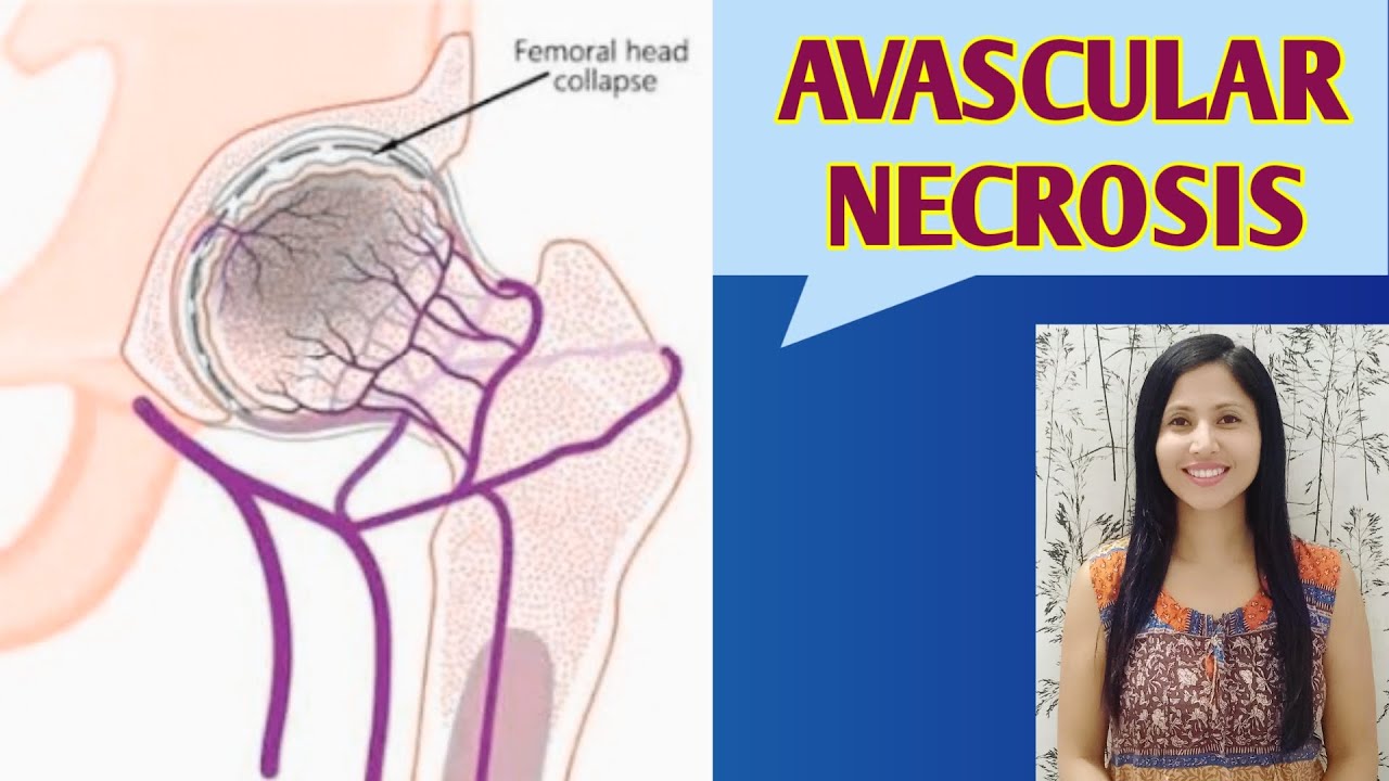 AVASCULAR NECROSIS IN HINDI| URDU| 2023, #physiotherapy, # ...