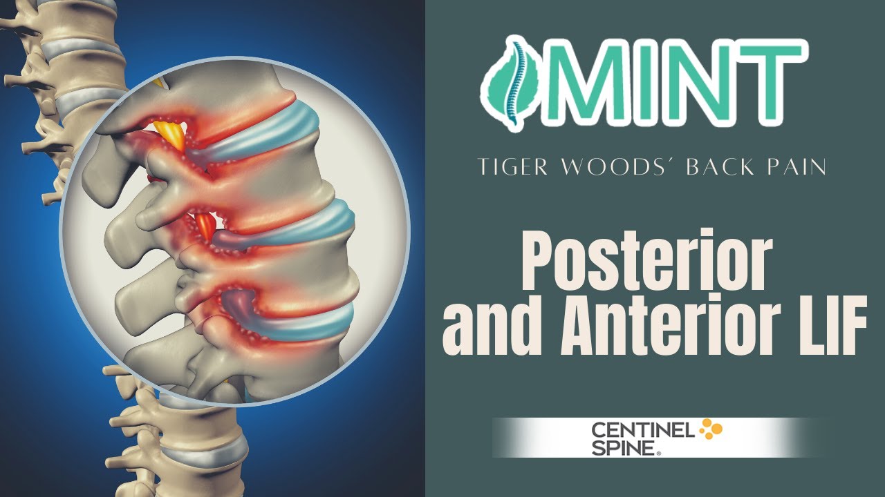 Tiger Woods’ Back Pain: Posterior and Anterior LIF – Dr. Scott Kutz ...