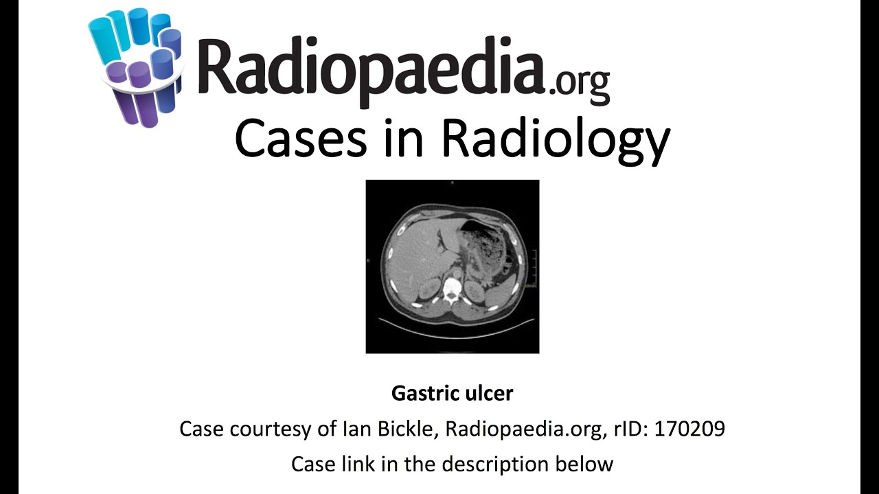 Gastric ulcer (Radiopaedia.org) Cases in Radiology - YouTube
