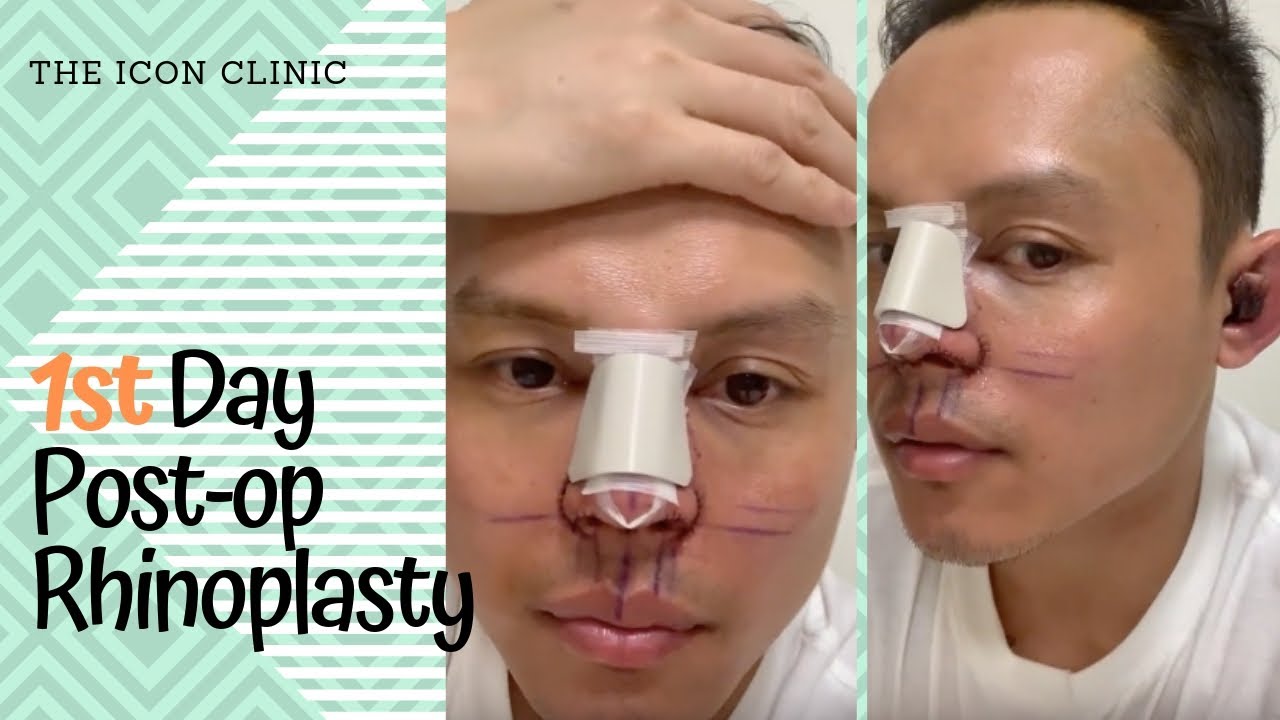 Rhinoplasty In the Philippines (1st Day Post Opp) - YouTube
