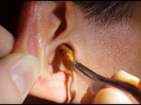 Ear wax extracted this ear - YouTube