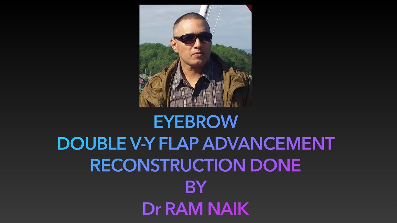 Eyebrow Double V-Y Flap Advancement Reconstruction Done. - YouTube