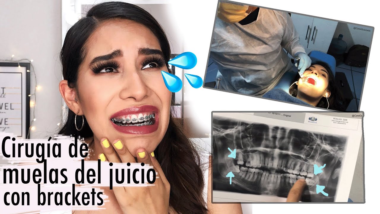 Mi experiencia con brackets 6 + CIRUGÍA DE MUELAS DEL JUICIO |Cirugía ...