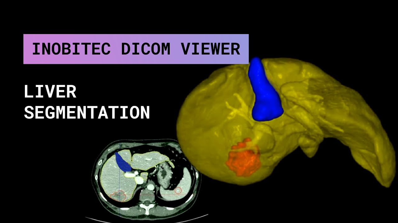 Liver segmentation in Inobitec DICOM Viewer Pro 2.3 - YouTube