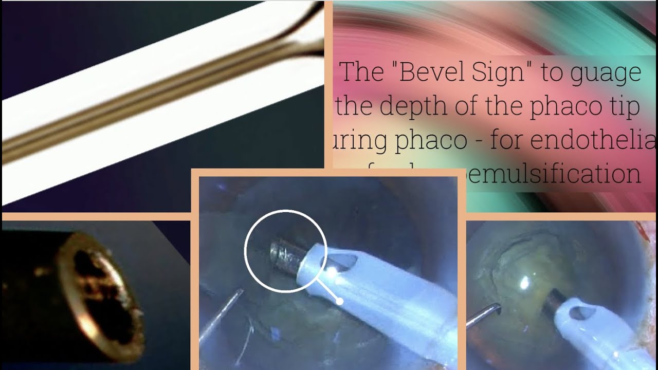 The Bevel Sign-to gauge the depth of the phaco probe in the anterior ...