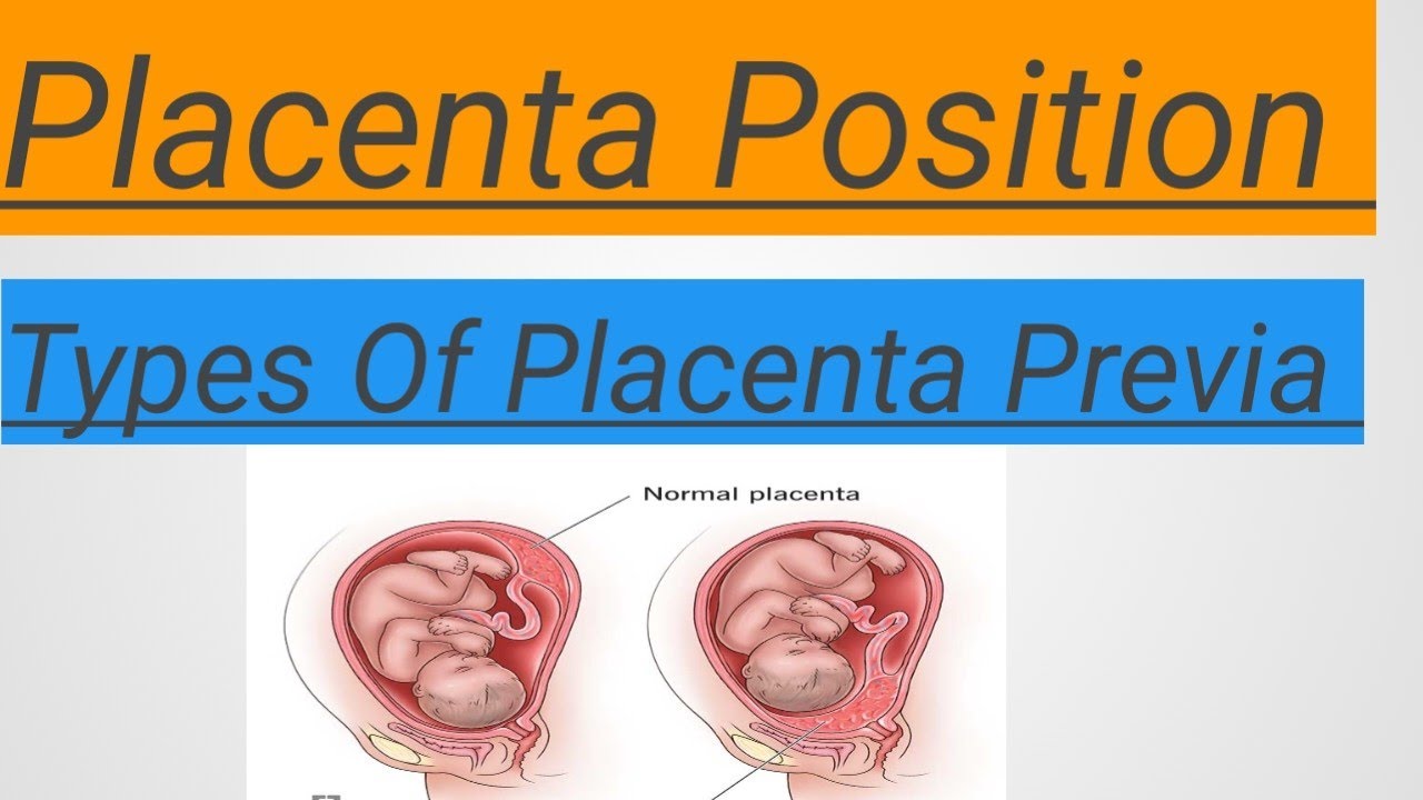 Types of Placenta position!Placenta Previa types!Grading of Placenta ...