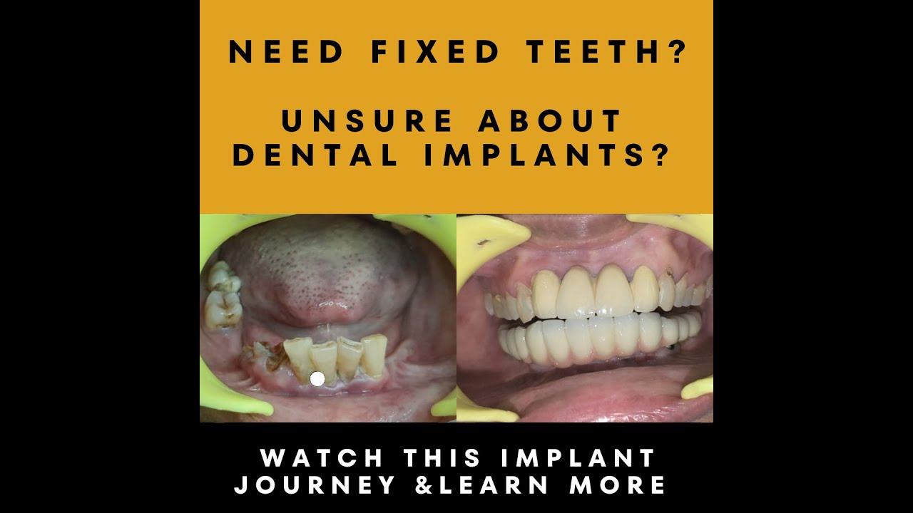 Watch the implant journey: From placement to fixed teeth - YouTube