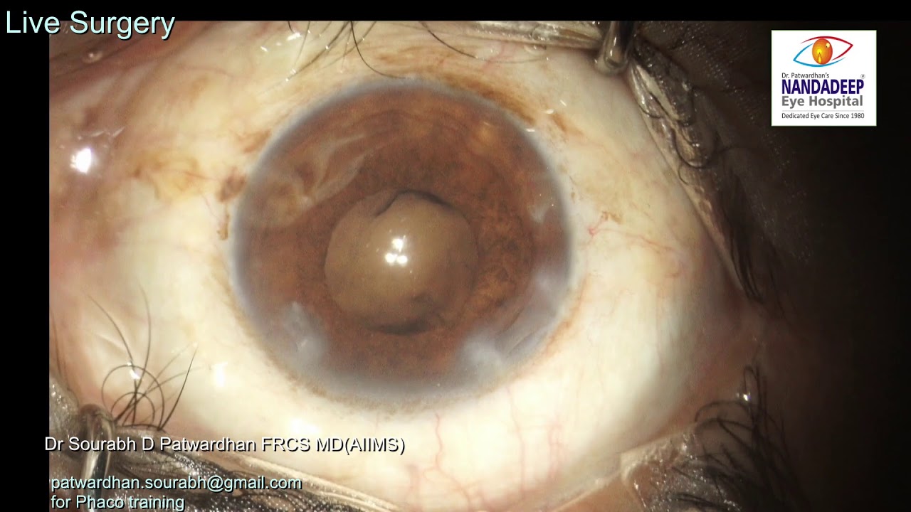 Live Surgery Hard cataract shallow AC Dr Sourabh D Patwardhan - YouTube