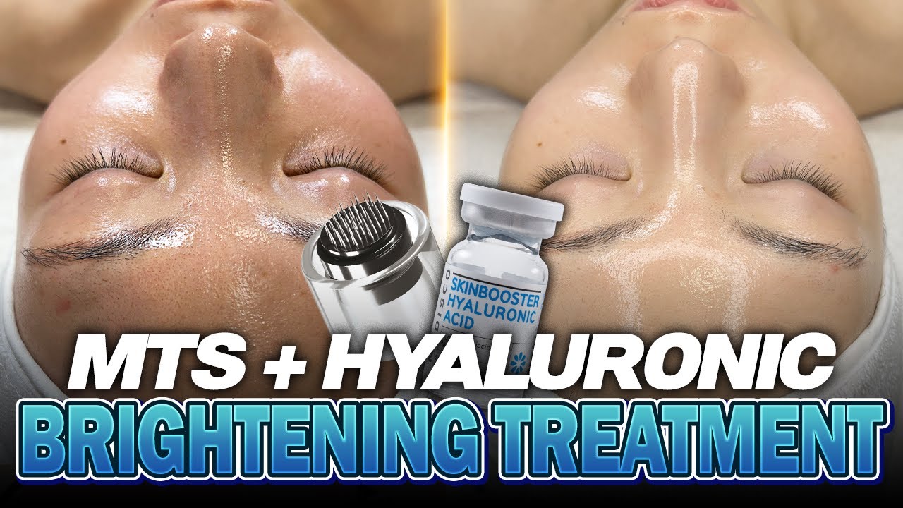 🌟 MTS Skin Booster: Hyaluronic Acid Procedure & Stunning Before & After ...