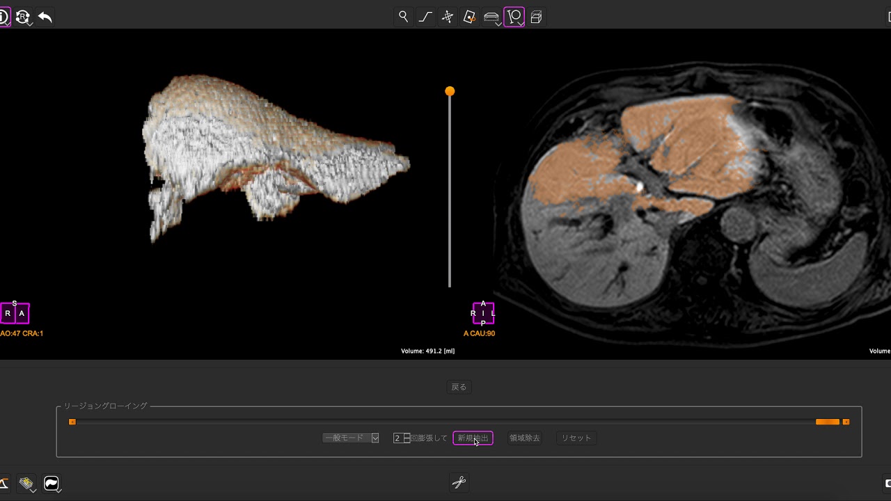 RegionGrowing for CE-MRI (EOB-Primovist) - YouTube