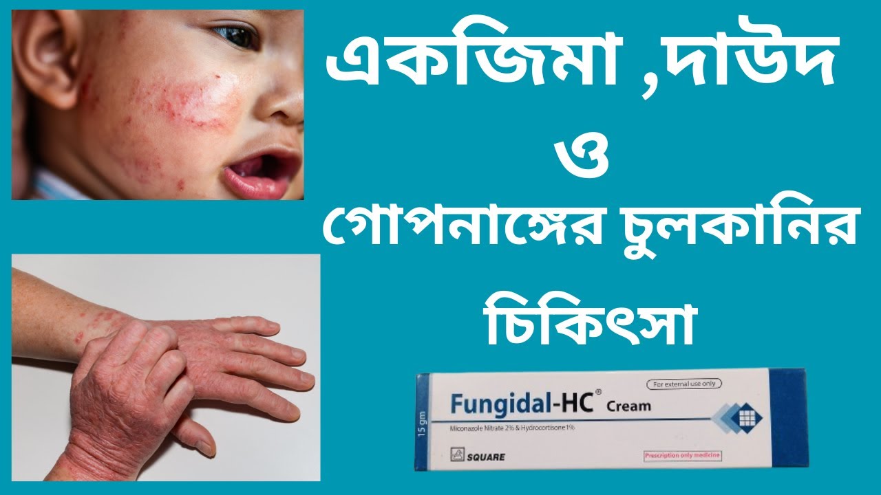 Fungal Infection in Private Parts Treatment | দাউদ একজিমা ও চুলকানির ...