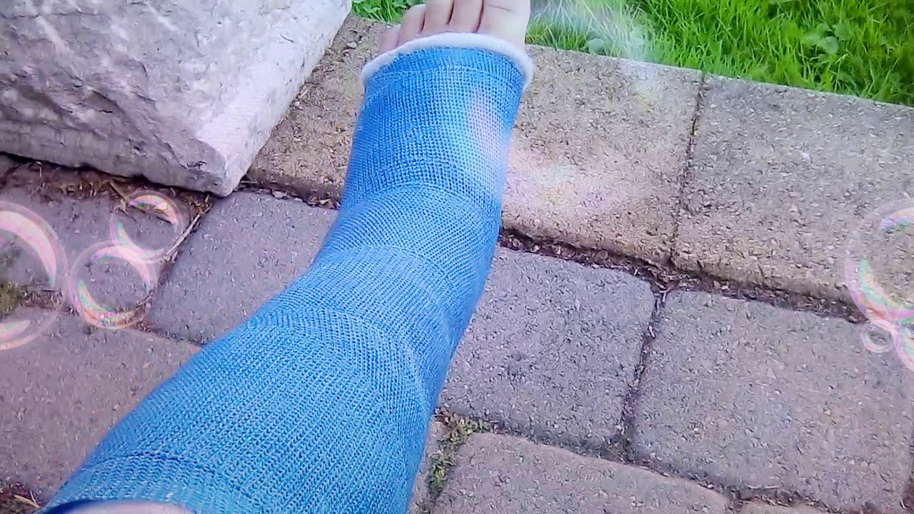 MY BROKEN LEG - YouTube