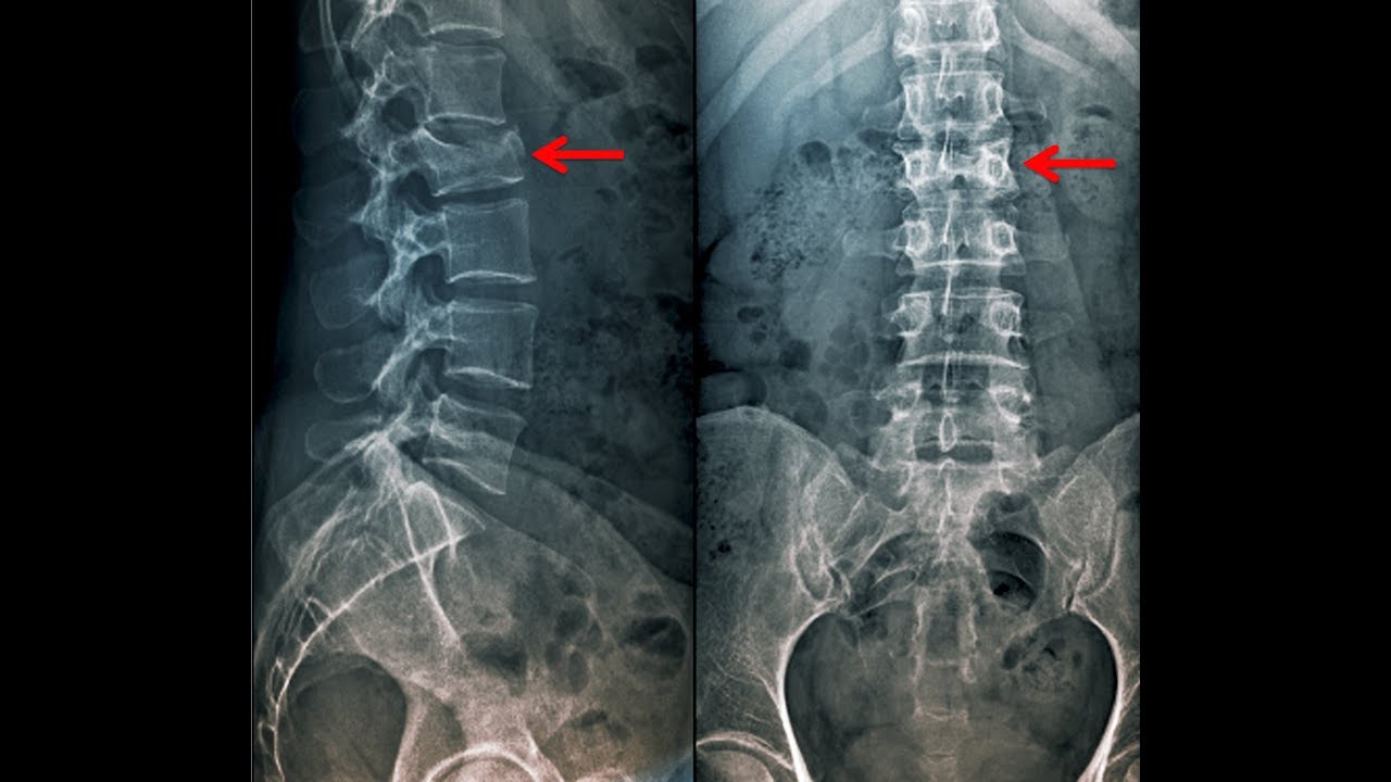 What is Vertebral Augmentation? | Dr. Tim Howard | Pain Management ...