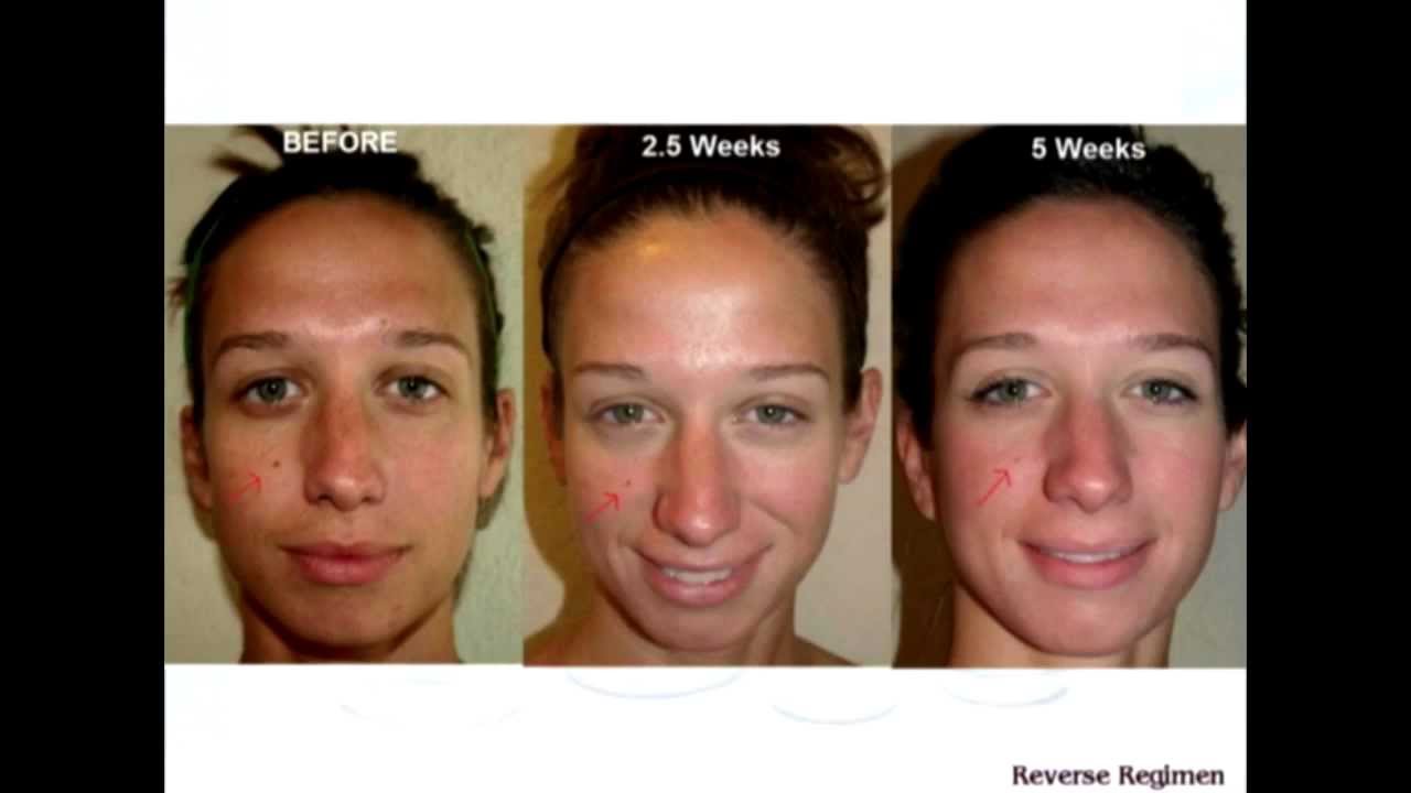 Rodan+Fields Reverse Regimen Before and After Picture Album - YouTube