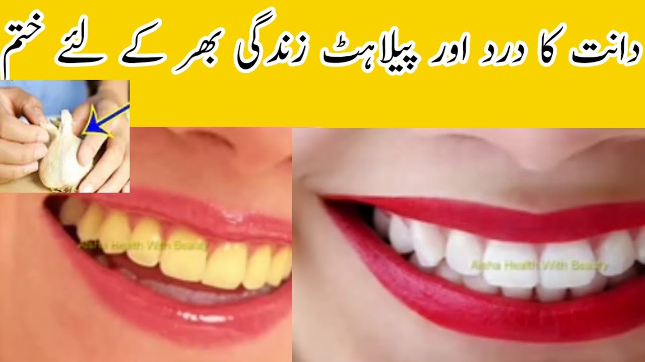 Dant ka dard or dant ka peela pan 2 mint mein khatm|teeth whitening ...