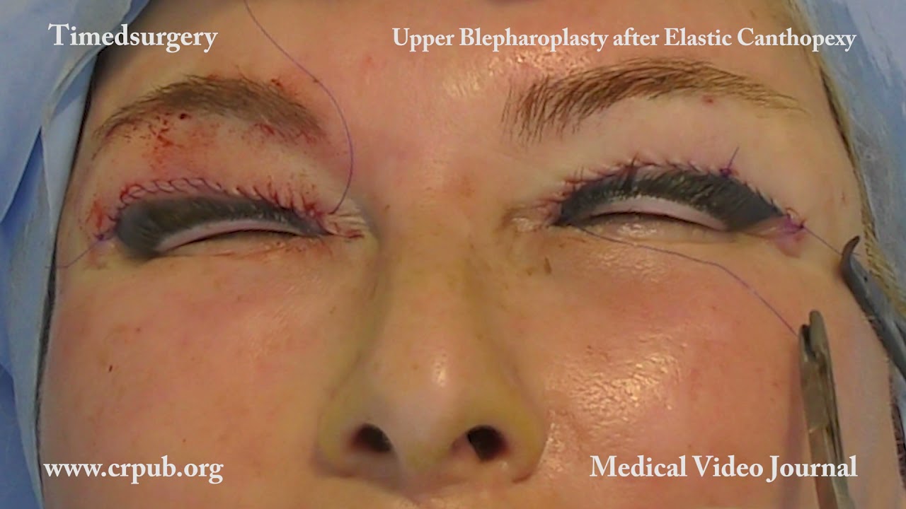 20. Upper Blepharoplasty after Elastic Canthopexy - YouTube