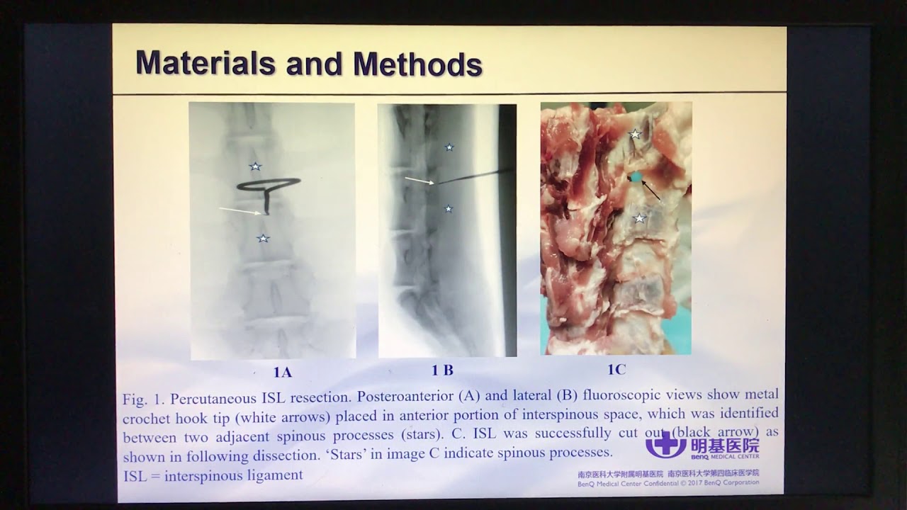 [Listen to Authors] CORONAL 3D-MRI IMPROVED DIAGNOSTIC ACCURACY OF PLC ...