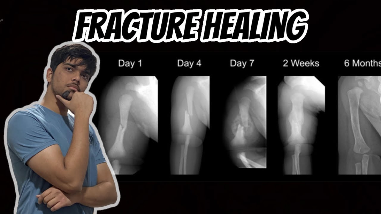 Fracture healing - Primary Vs Secondary healing & Woven Vs Lamellar ...