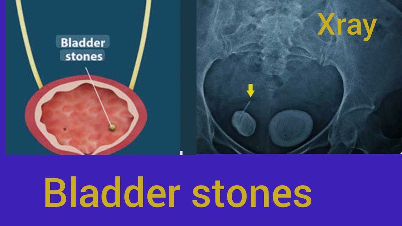 Preperation of Bladder Stone and instrument Set Tips - YouTube