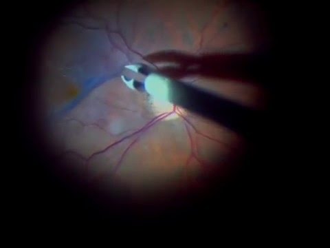Epiretinal Membrane Peeling 1. Erich Schmidt MD 2007 - YouTube