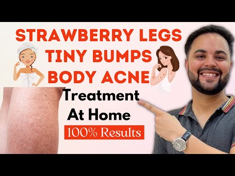 Strawberry Legs ,Tiny Bumps & Body Acne Treatment at Home ||100% Results