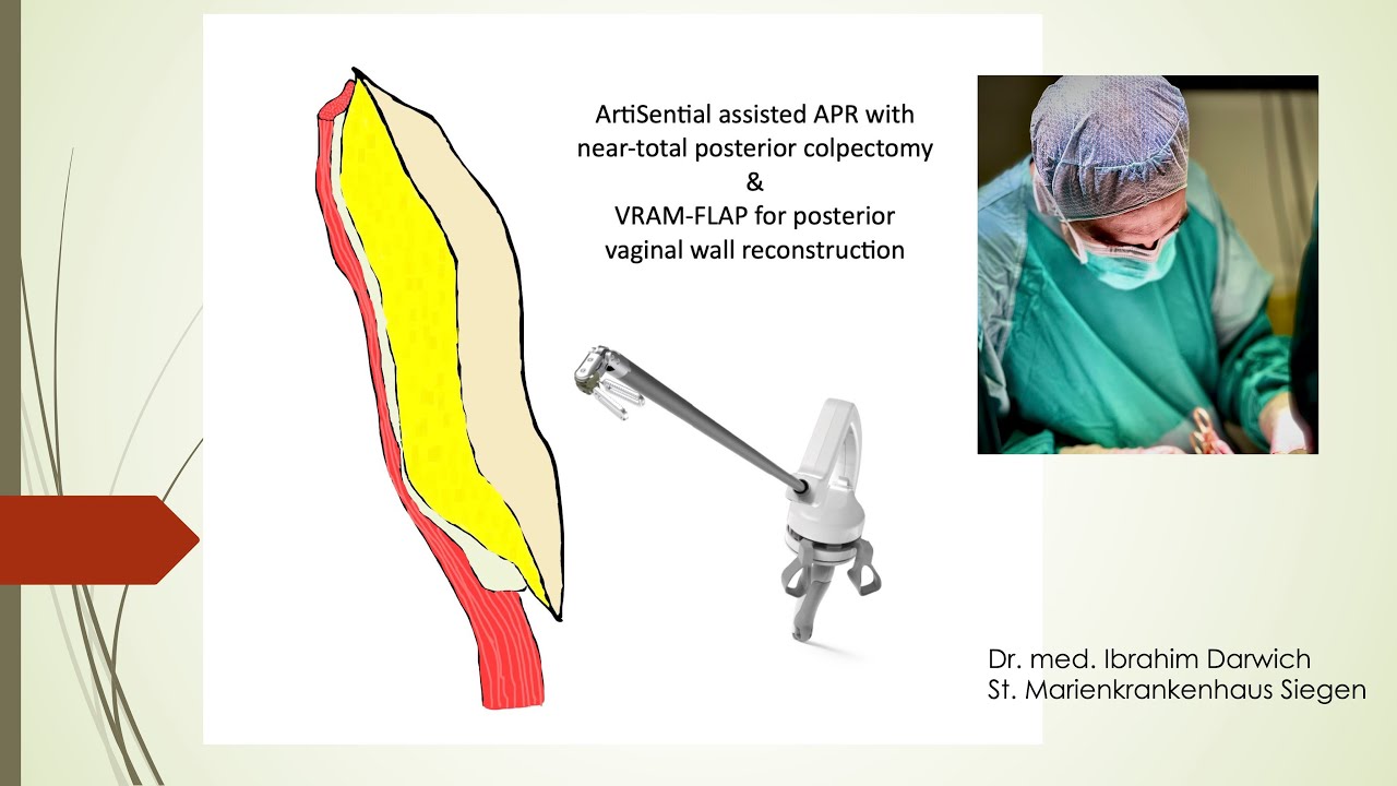 #ArtiSential Abdominoperineal Resection with posterior Colpectomy and ...